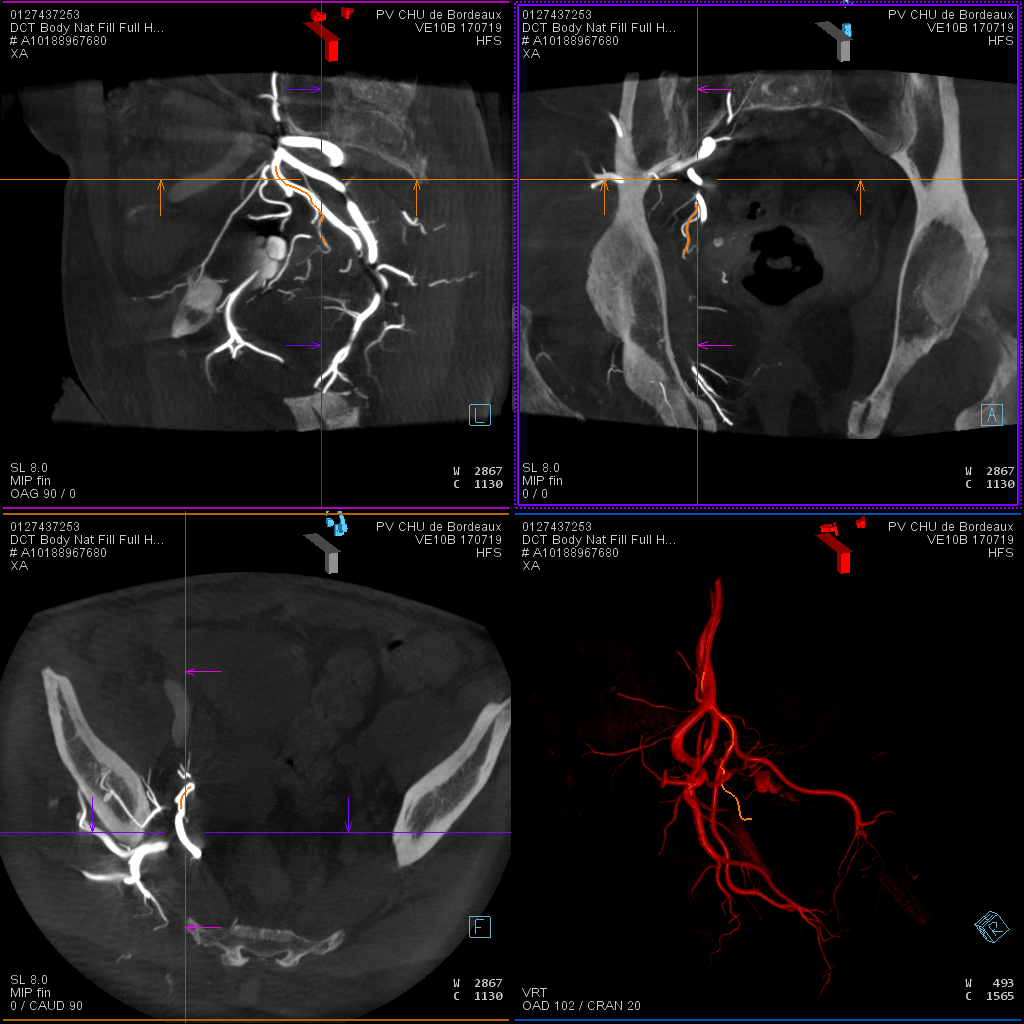 Embolisation de la prostate - Radiologie Interventionnelle embolisation