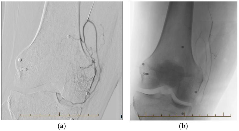 Embolisation d'arthrose - Radiologie Interventionnelle