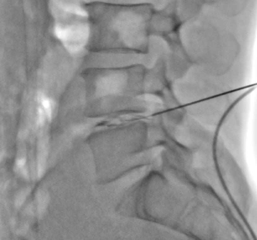 Infiltration Intra discale - Radiologie Interventionnelle