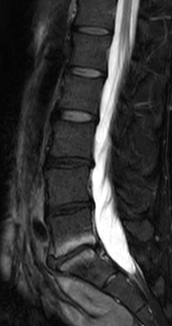 Infiltration Intra discale - Radiologie Interventionnelle